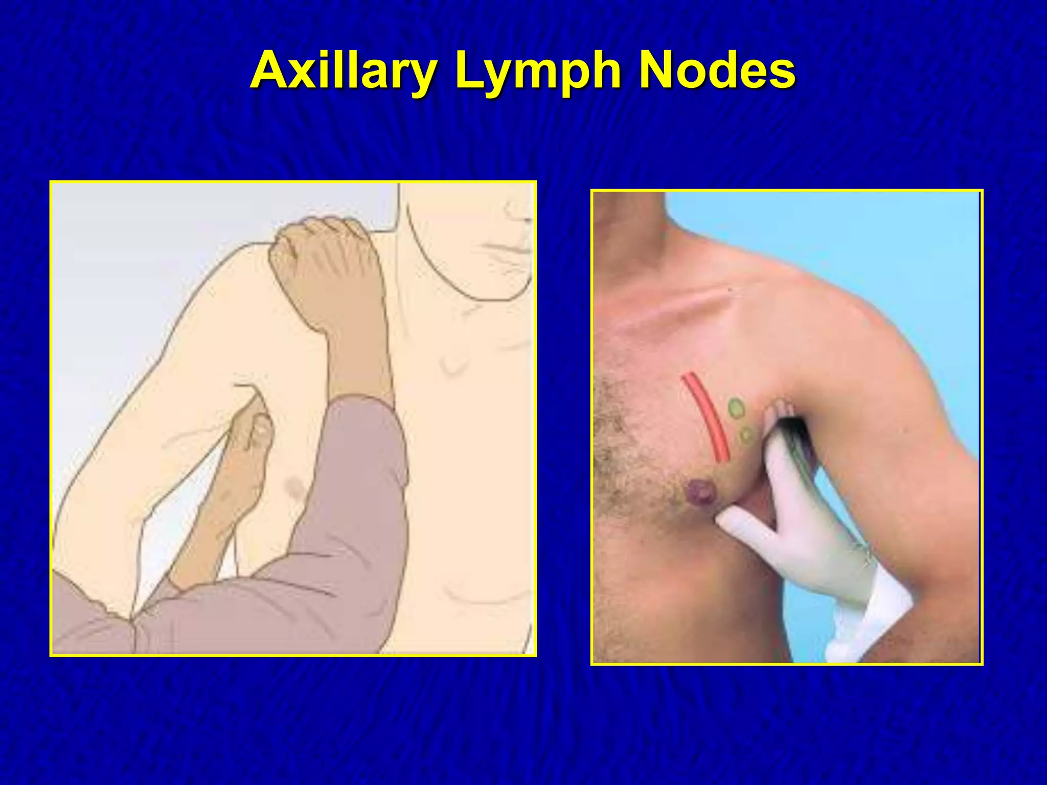 Axillary Lymph Nodes Examination.pptx