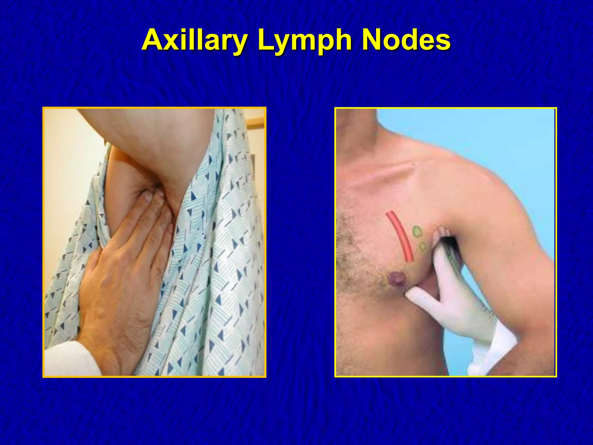 Axillary Lymph Nodes Examinationpptx