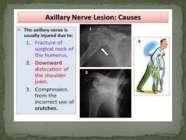 Axillary nerve palsy | PPTX