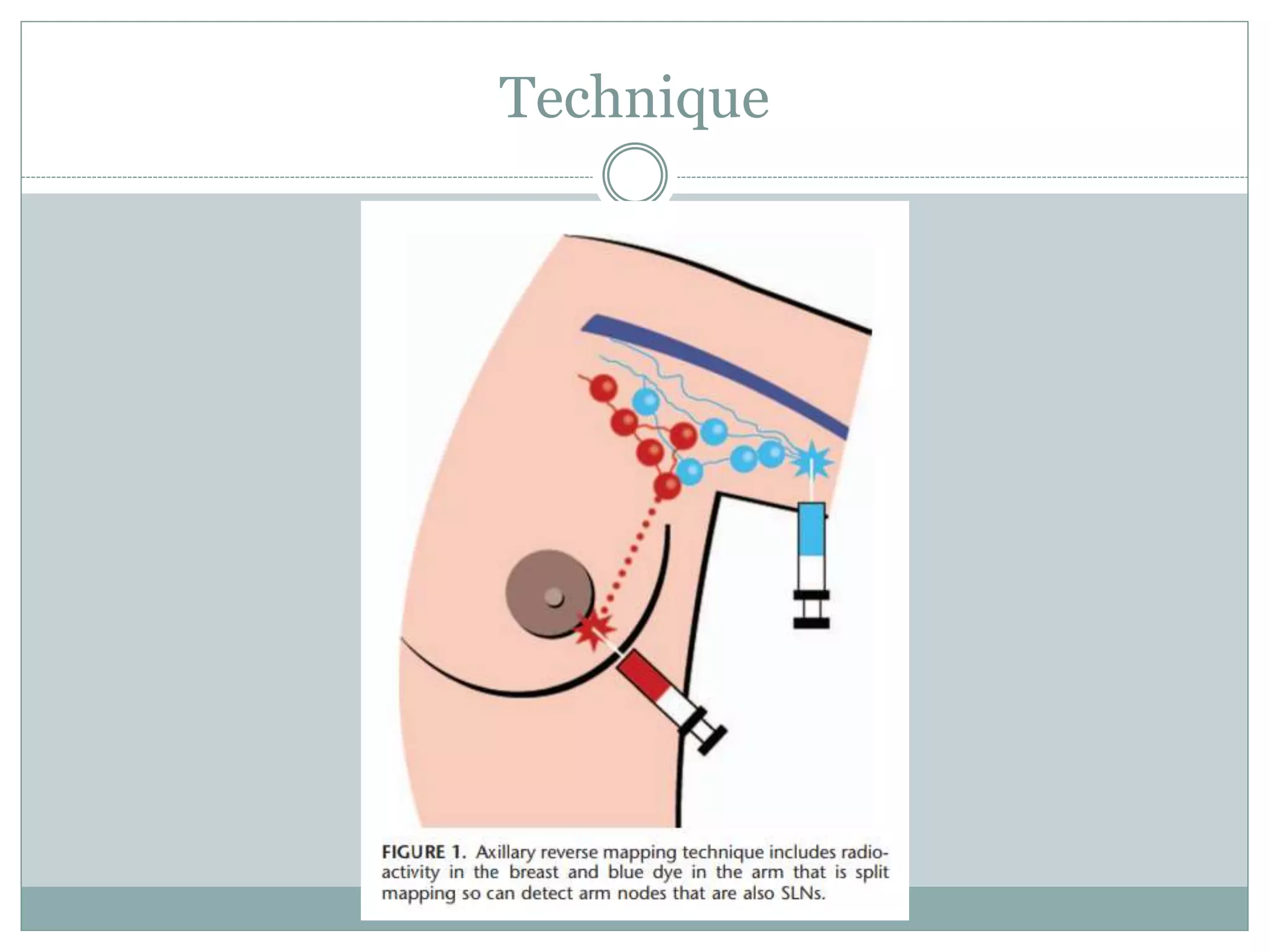 Axillary reverse mapping | PPTX