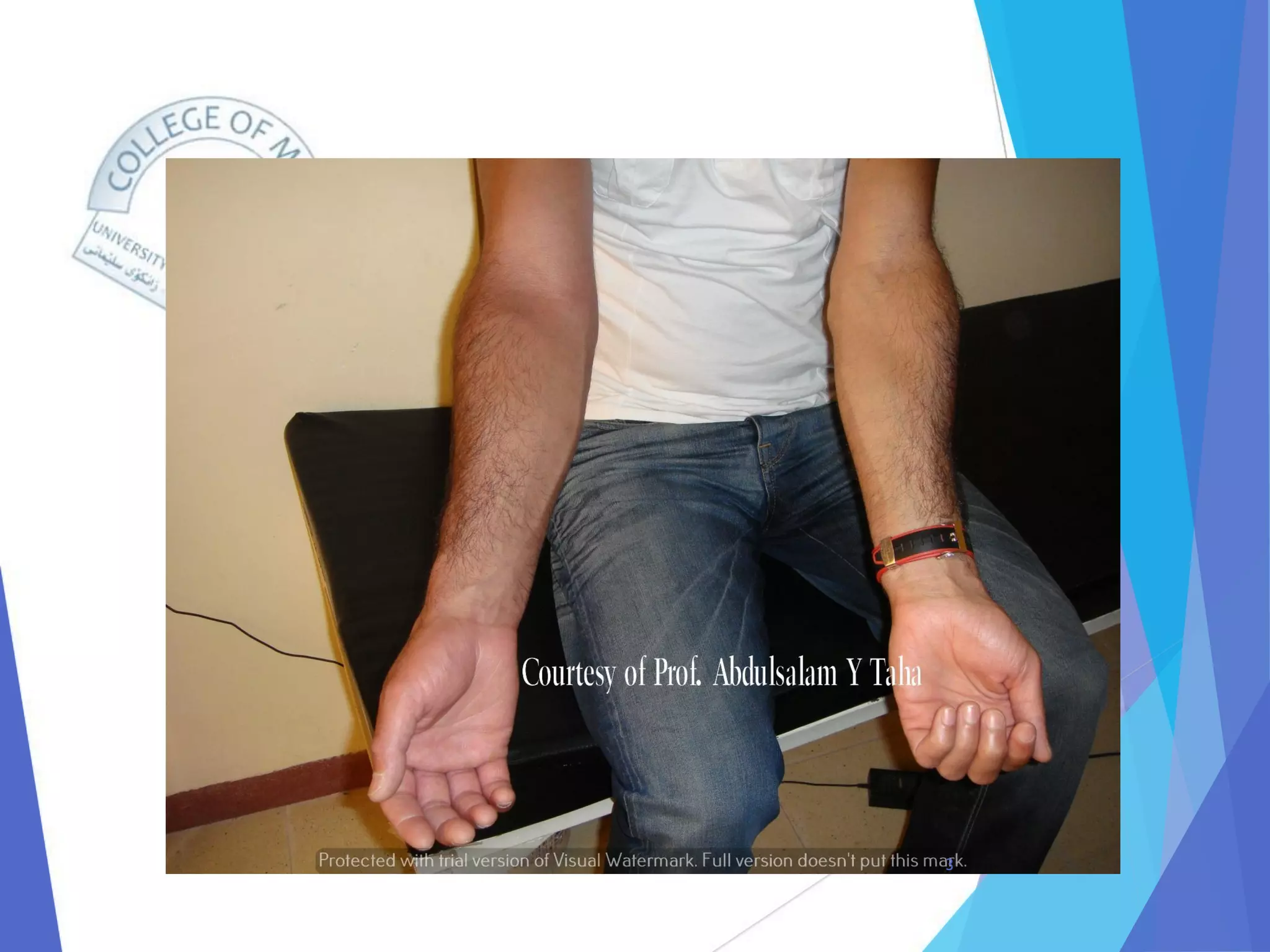 Axillary Vein Thrombosis.pdf