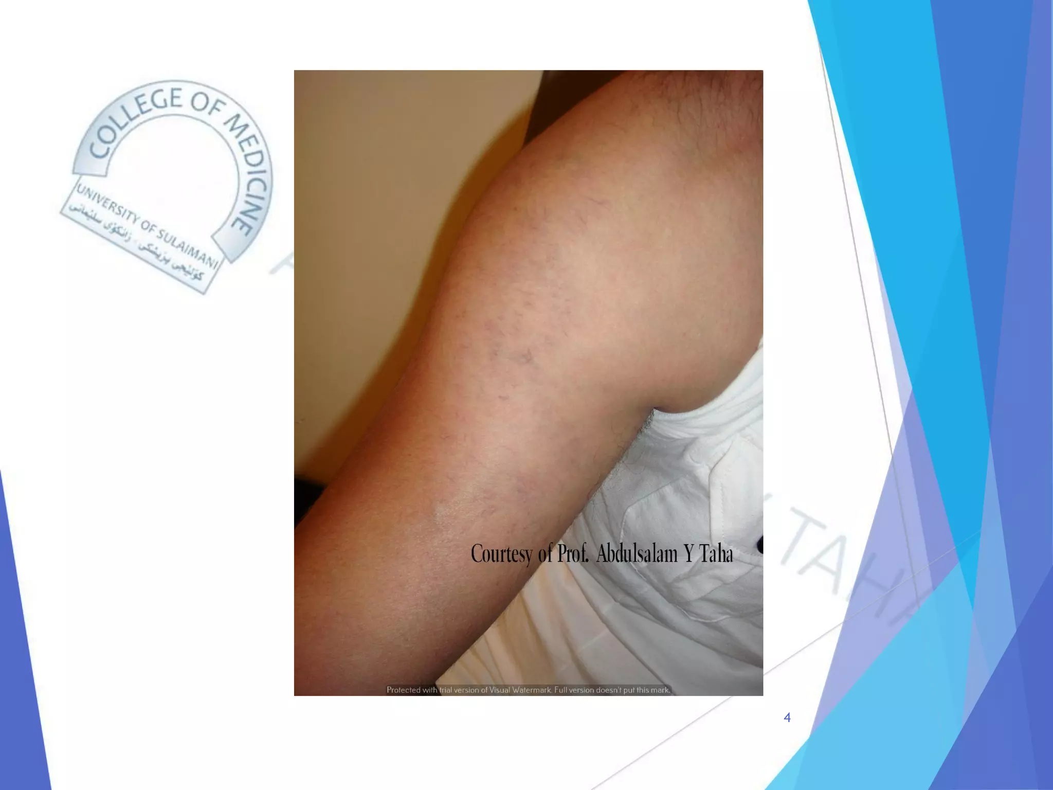 Axillary Vein Thrombosis.pdf