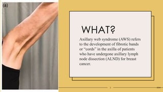 AXILLARY WEB SYNDROME physiotherapy.pptx