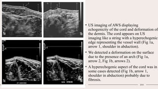 AXILLARY WEB SYNDROME physiotherapy.pptx