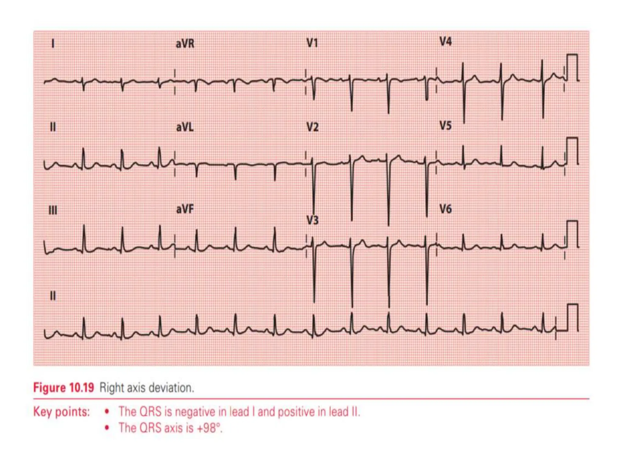 AXIS, TYPES OF AXIS IN ECG AND HOW TO INTERPRET IN ECG? | PPTX