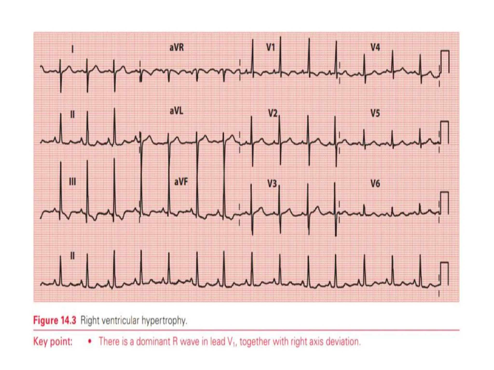 AXIS, TYPES OF AXIS IN ECG AND HOW TO INTERPRET IN ECG? | PPTX