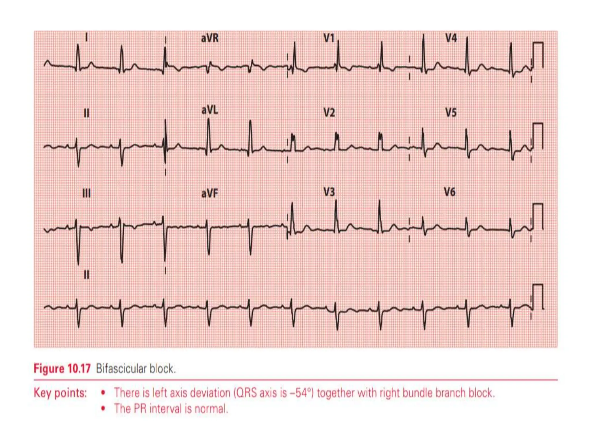AXIS, TYPES OF AXIS IN ECG AND HOW TO INTERPRET IN ECG? | PPTX