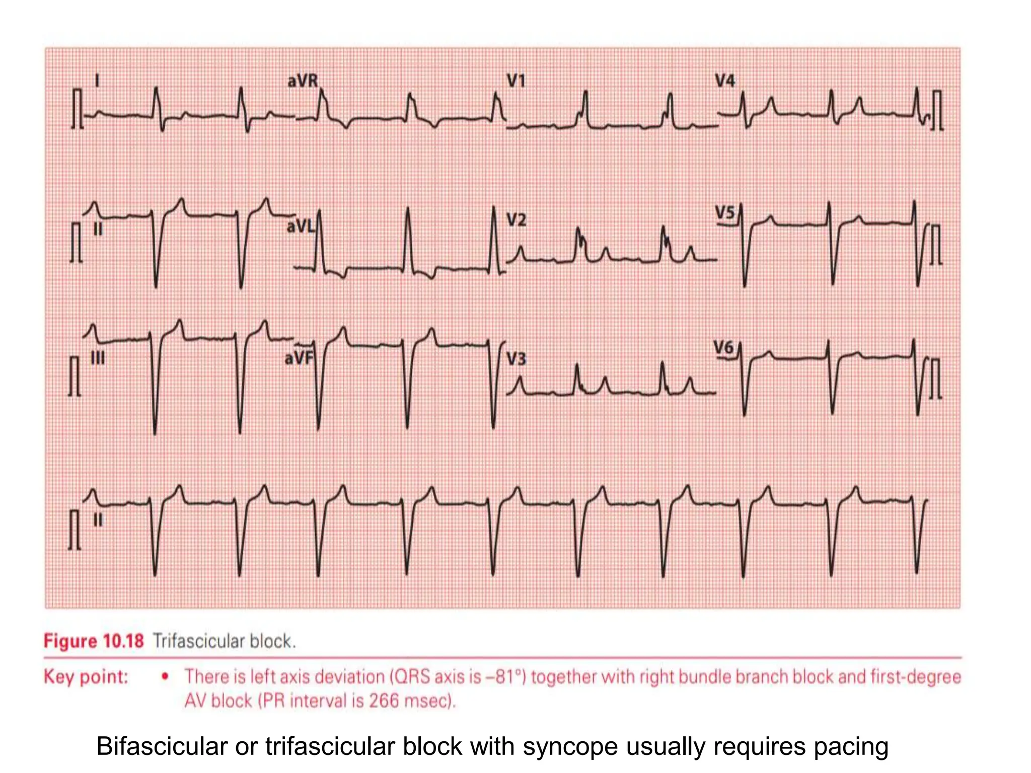 AXIS, TYPES OF AXIS IN ECG AND HOW TO INTERPRET IN ECG? | PPTX