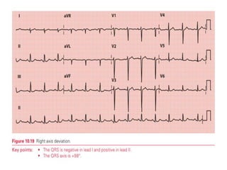 AXIS, TYPES OF AXIS IN ECG AND HOW TO INTERPRET IN ECG? | PPTX