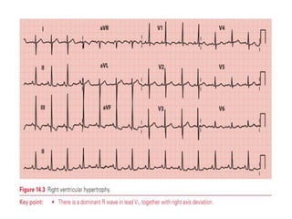 AXIS, TYPES OF AXIS IN ECG AND HOW TO INTERPRET IN ECG? | PPTX