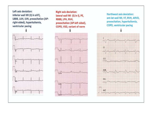 AXIS, TYPES OF AXIS IN ECG AND HOW TO INTERPRET IN ECG? | PPTX