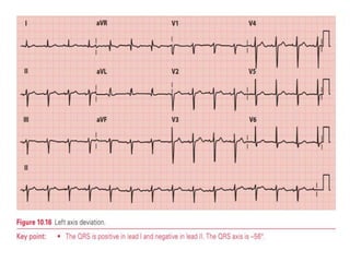 AXIS, TYPES OF AXIS IN ECG AND HOW TO INTERPRET IN ECG? | PPTX