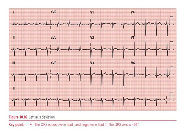 AXIS, TYPES OF AXIS IN ECG AND HOW TO INTERPRET IN ECG? | PPTX