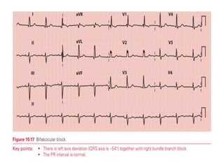 AXIS, TYPES OF AXIS IN ECG AND HOW TO INTERPRET IN ECG? | PPTX