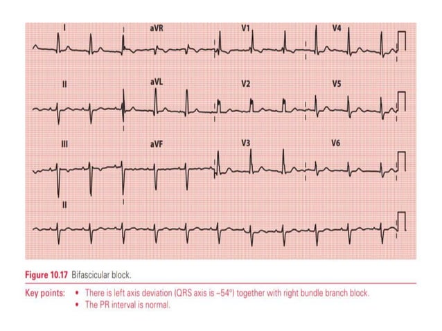 AXIS, TYPES OF AXIS IN ECG AND HOW TO INTERPRET IN ECG? | PPTX