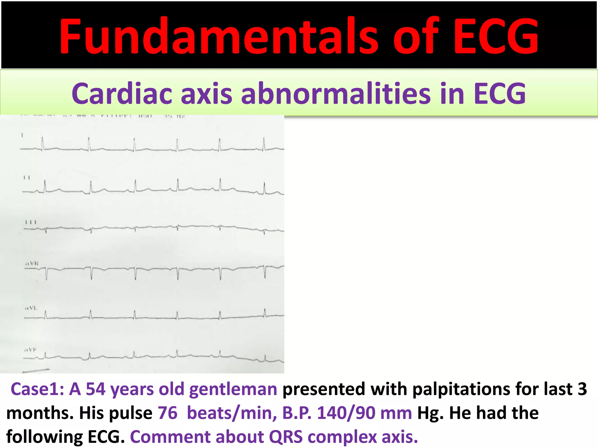 Cardiac axis abnormalities in ECG | PPTX