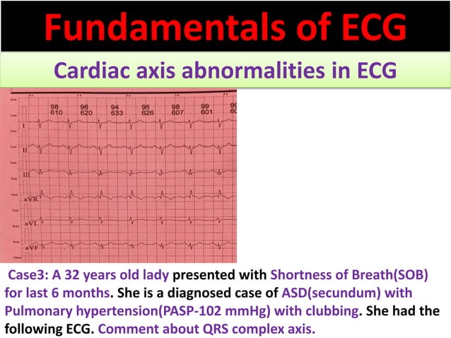 Cardiac axis abnormalities in ECG | PPTX