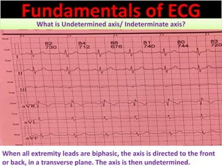Cardiac axis abnormalities in ECG | PPTX