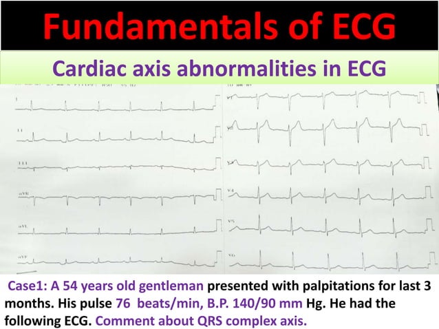 Cardiac axis abnormalities in ECG | PPTX