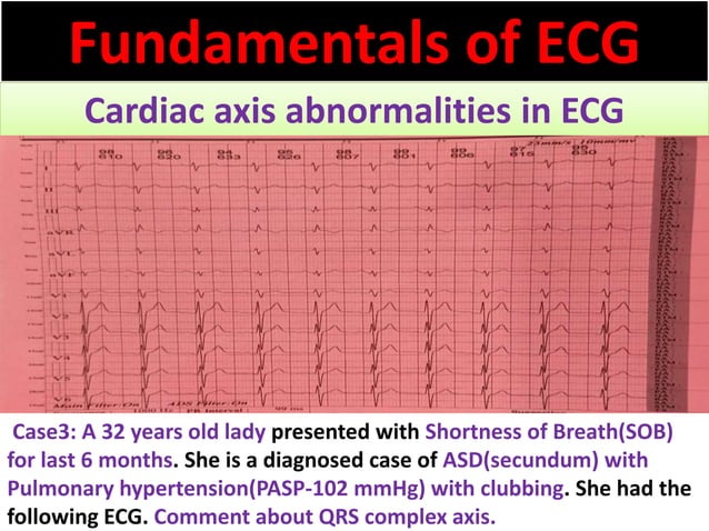 Cardiac axis abnormalities in ECG | PPTX