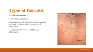 Psoriasis | PPTX