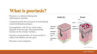 Psoriasis | PPT