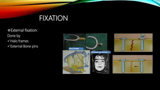 Mandibular fracture and its Management | PPTX
