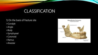 Mandibular fracture and its Management | PPTX