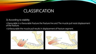 Mandibular fracture and its Management | PPTX
