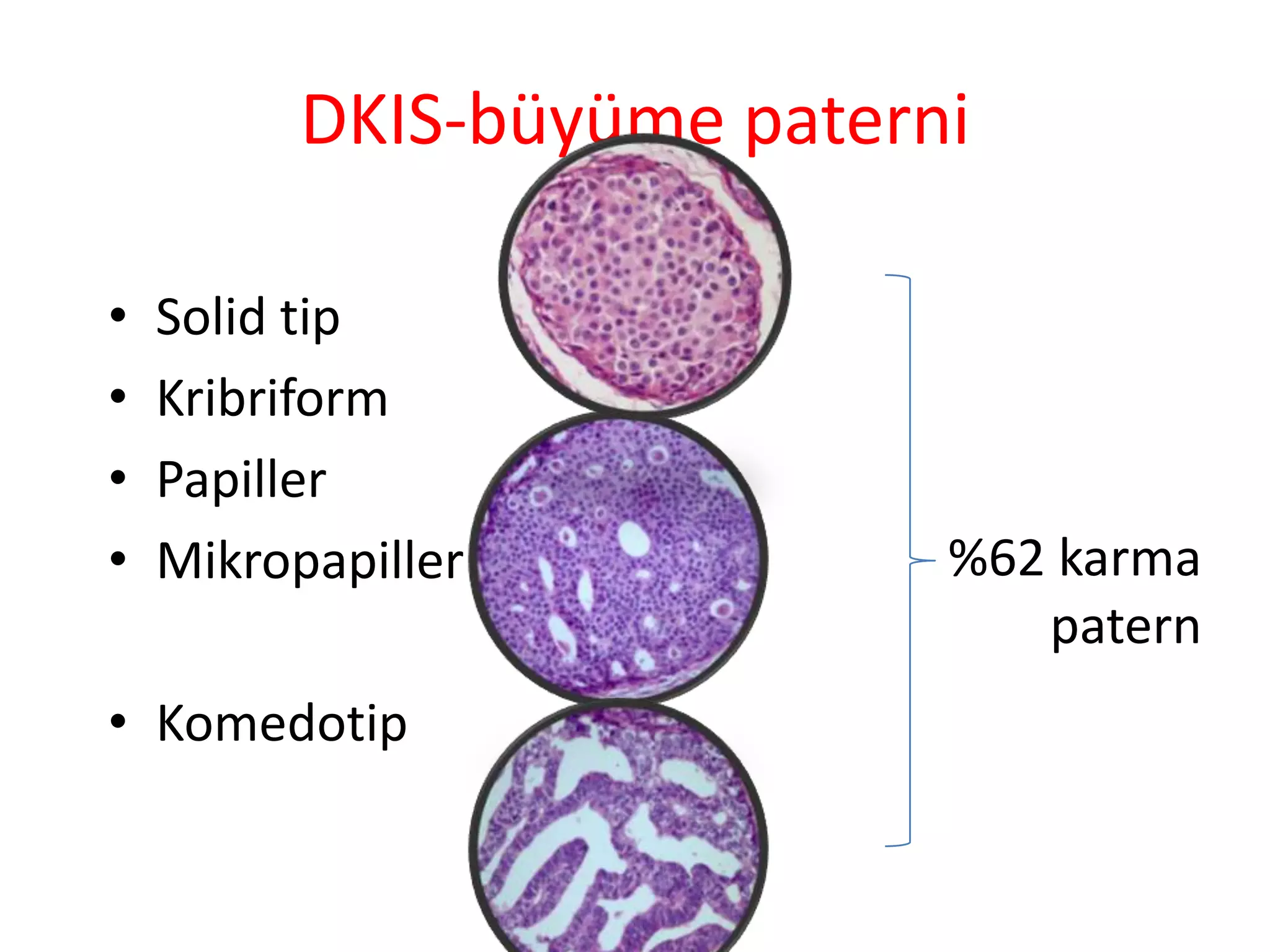 duktal karsinoma insitu - patoloji | PPTX