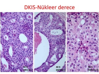 duktal karsinoma insitu - patoloji | PPTX
