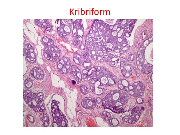 duktal carcinoma insitu -patoloji 02