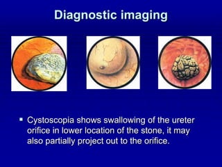 Urolithiasis ppt.pptx