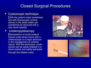 Urolithiasis ppt.pptx | Digestive Disorders | Diseases and Conditions