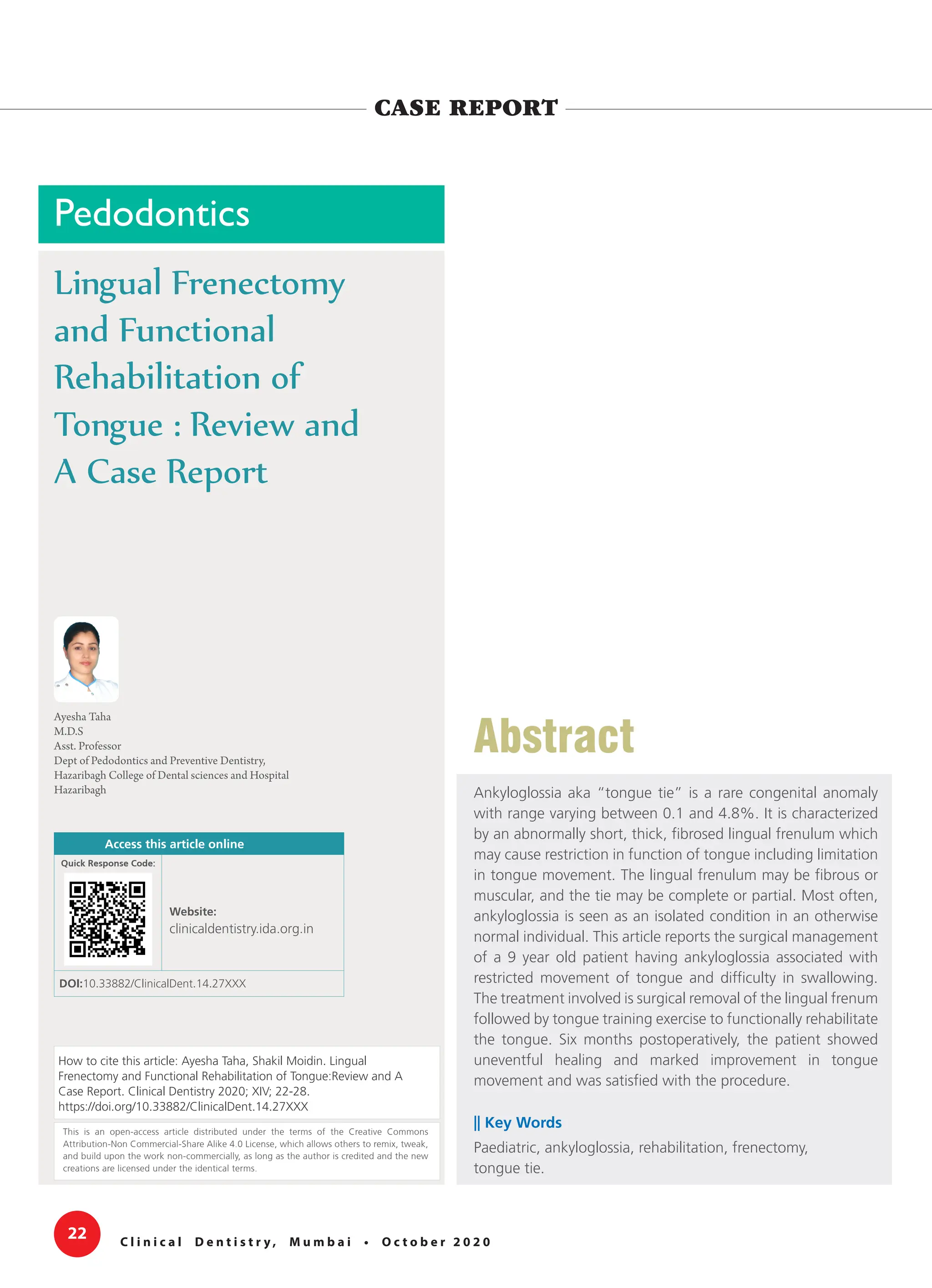 Ayesha_Lingual Frenectomy in pediatrc dental patient | PDF