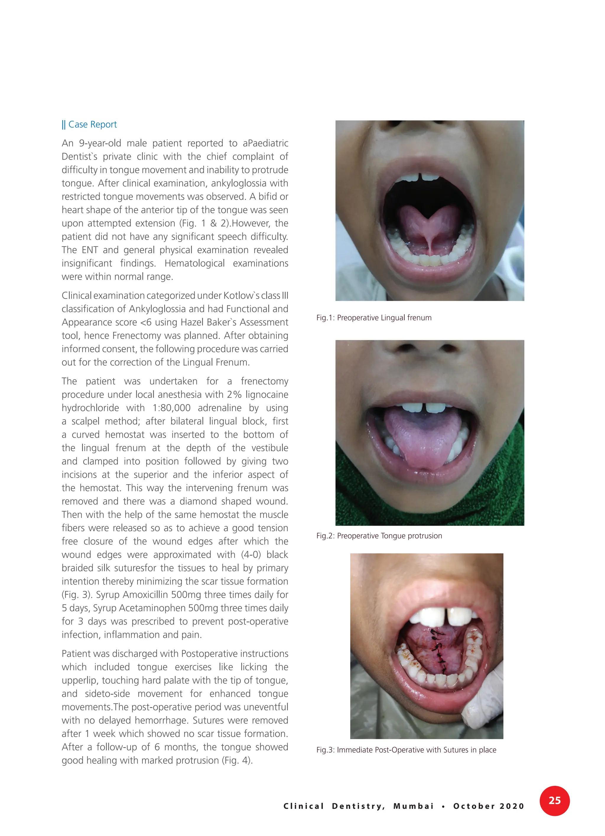 Ayesha_Lingual Frenectomy in pediatrc dental patient | PDF