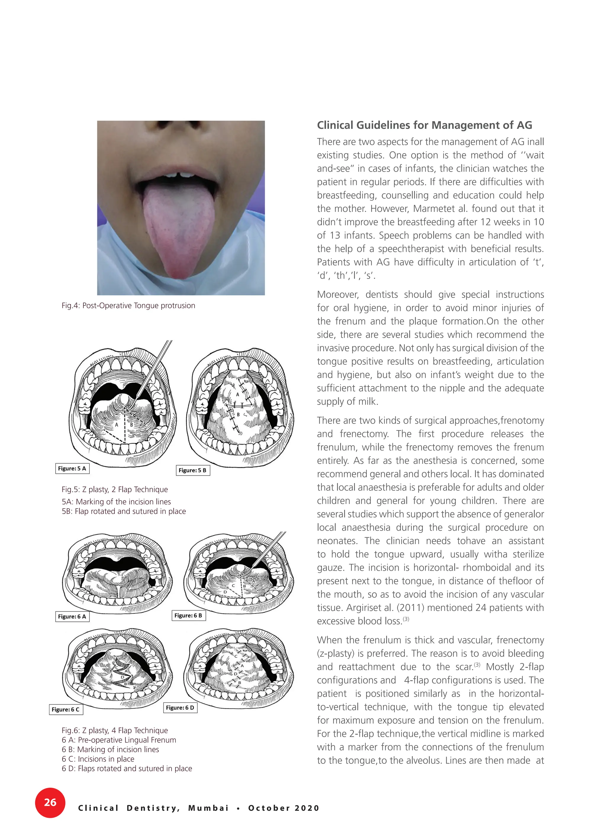 Ayesha_Lingual Frenectomy in pediatrc dental patient | PDF