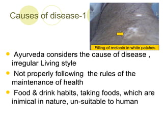 Ayurveda : Cure of Leucoderma | PPT