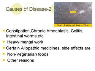 Ayurveda : Cure of Leucoderma | PPT