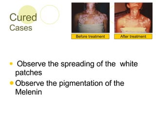 Ayurveda Cure Of Leucoderma | PPT
