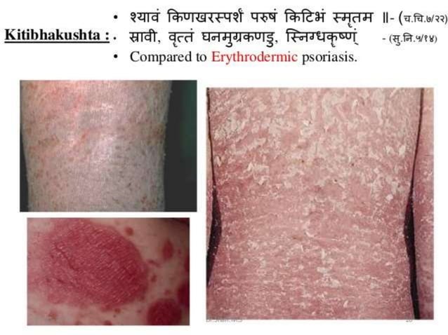 Ayurvedic management of skin diseases | PPTX | Skin and Dermatology ...