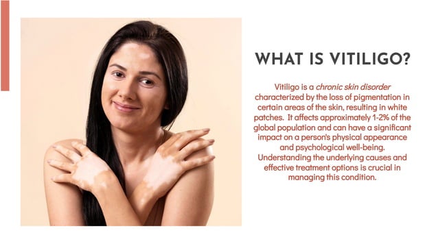 Ayurvedic medicine for Vitiligo treatment.pdf
