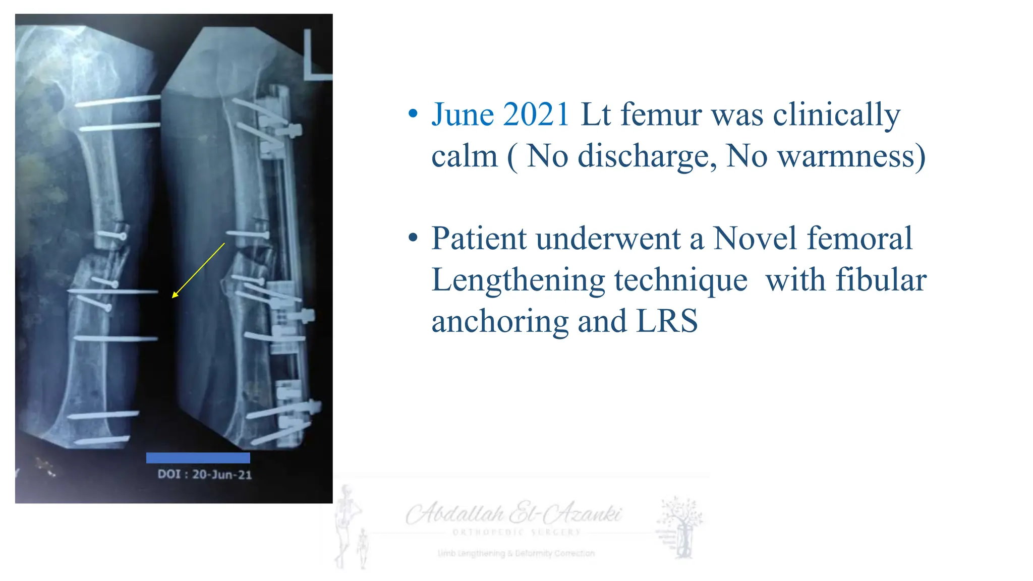 Complex Femoral Fracture Scenario | PPT