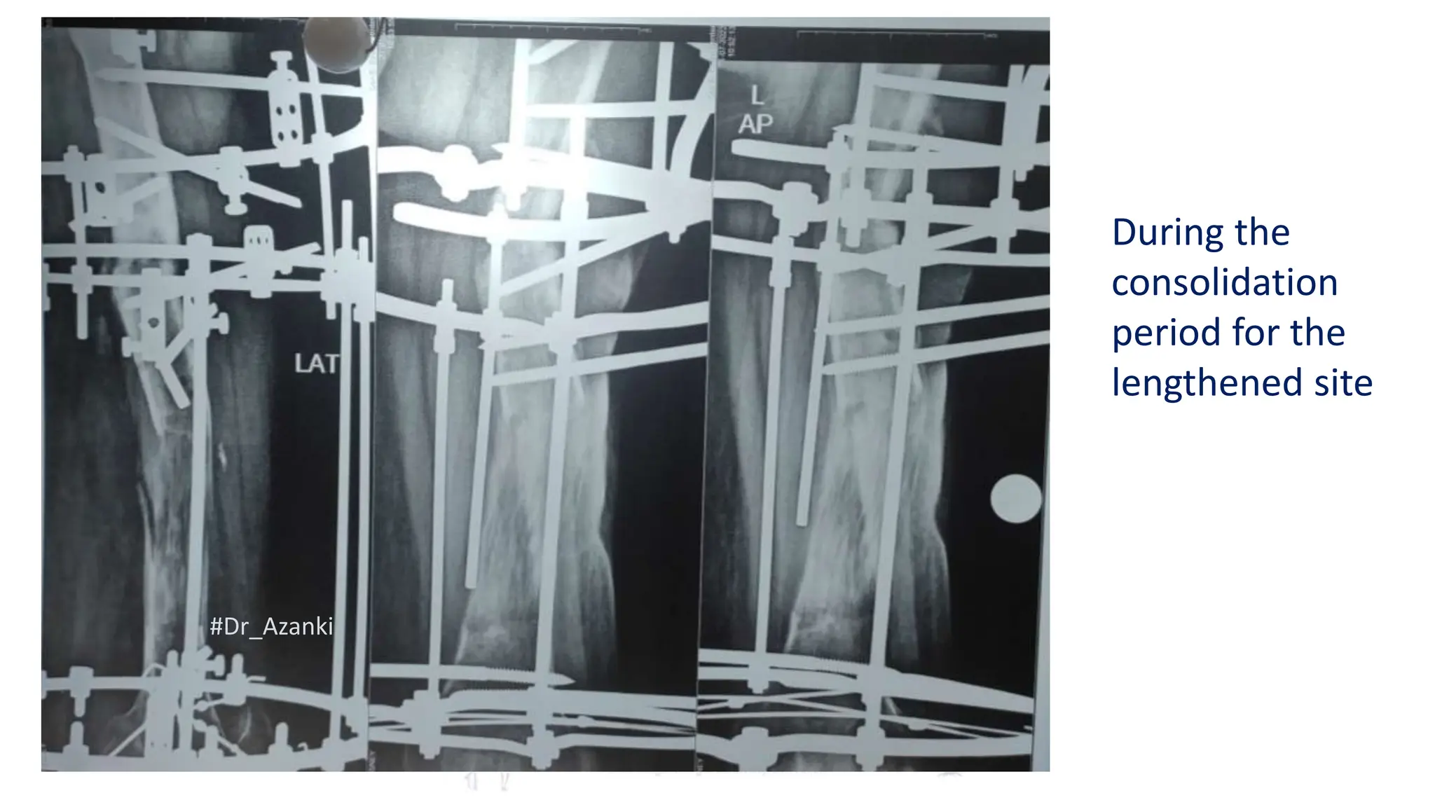 Complex Femoral Fracture Scenario | PPT