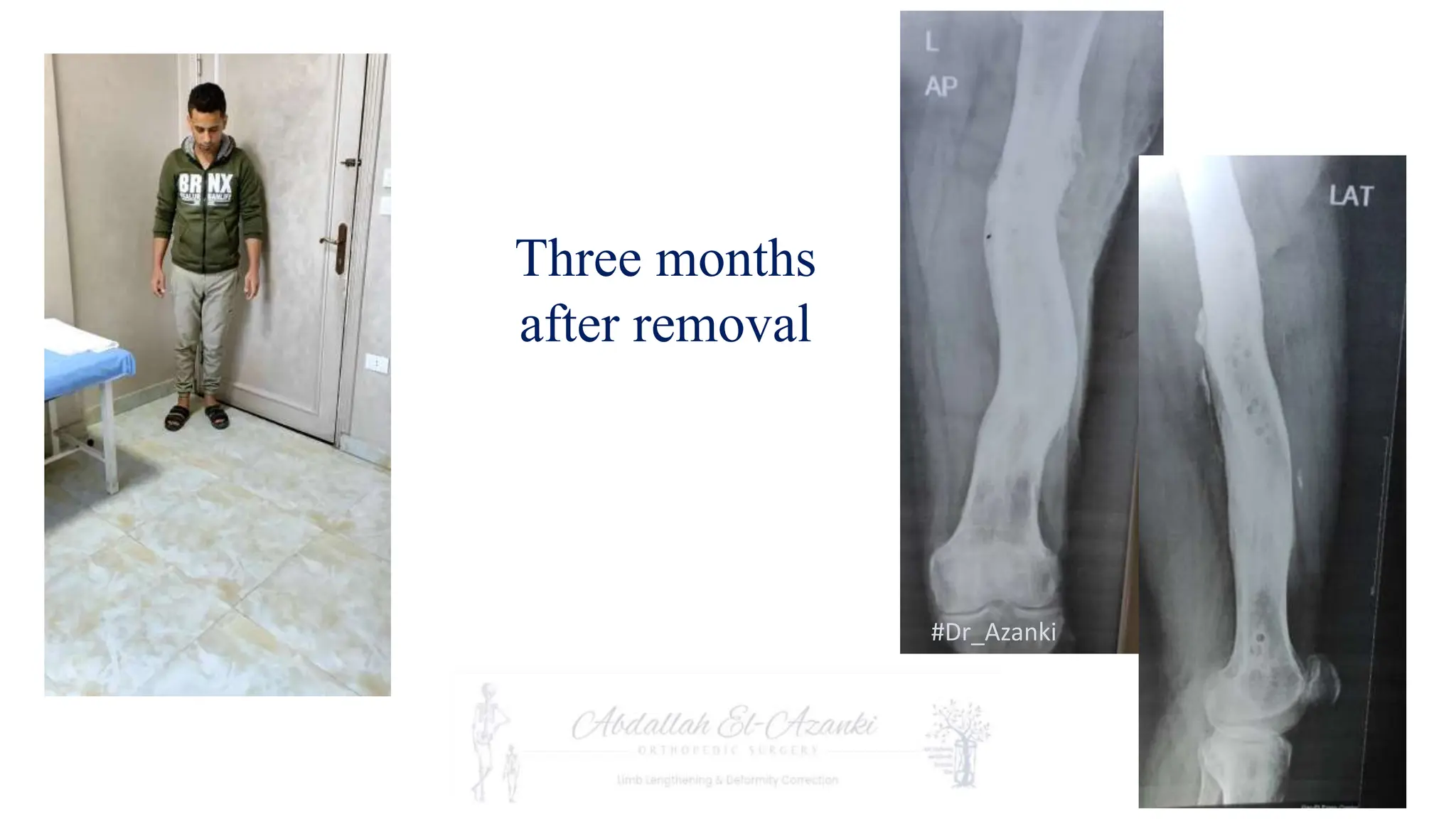 Complex Femoral Fracture Scenario | PPT