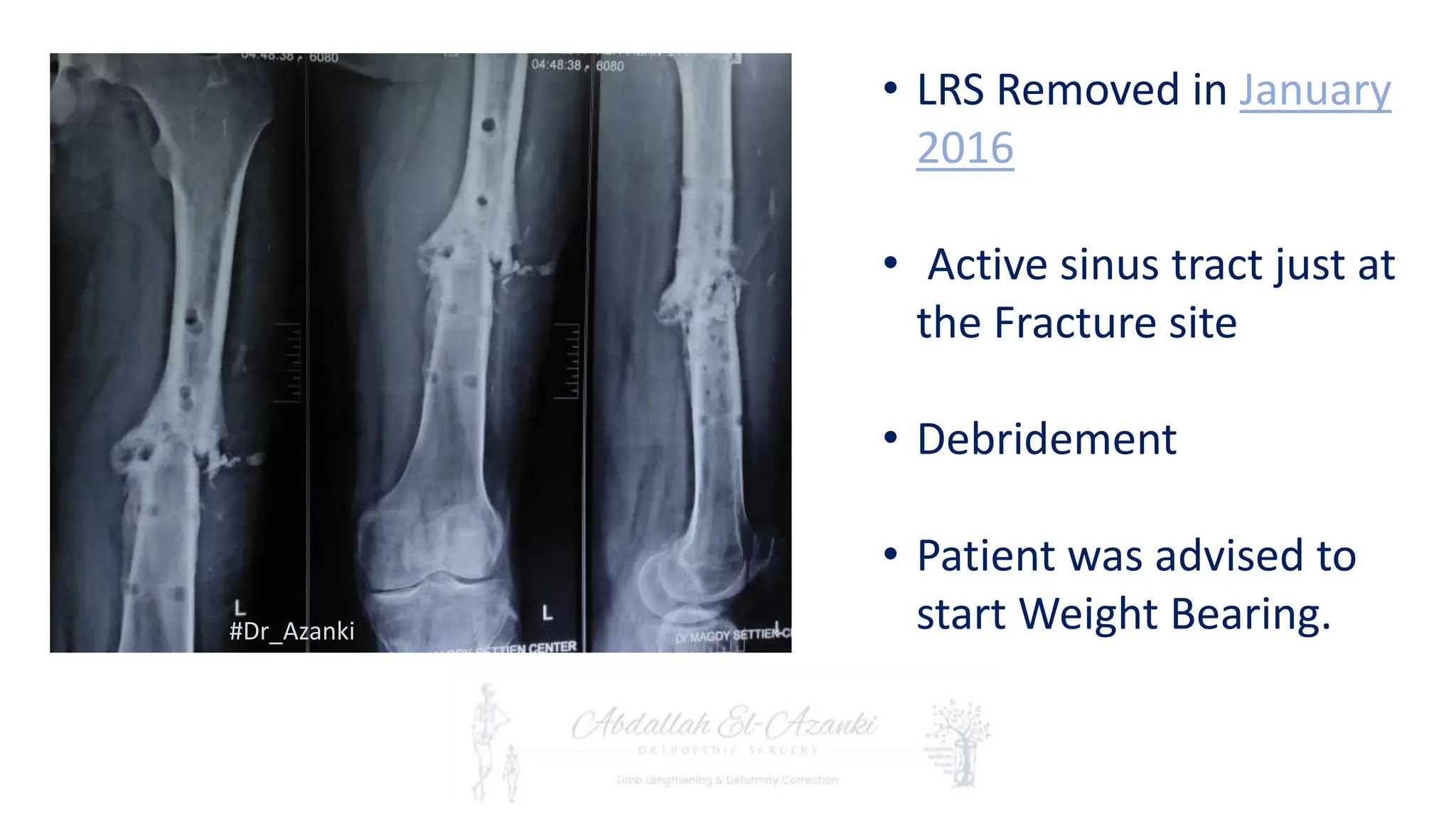 Complex Femoral Fracture Scenario | PPT