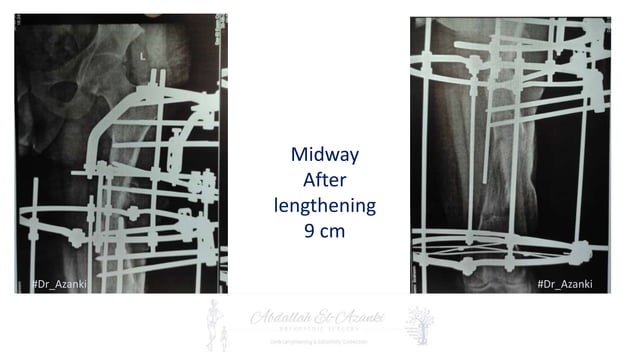Complex Femoral Fracture Scenario | PPT