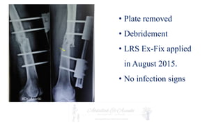 Complex Femoral Fracture Scenario | PPT