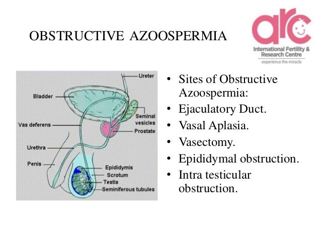 Azoospermia by Dr.Saravanan