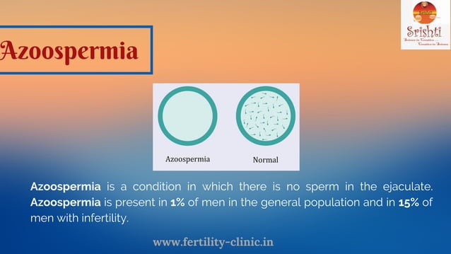 Azoospermia: Causes, Diagnosis and Treatment | PDF